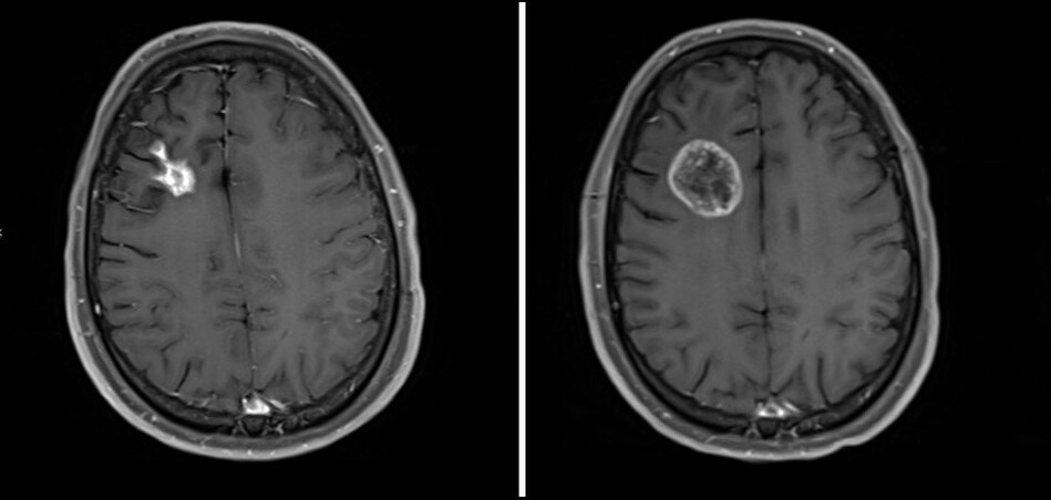 New trial seeks to reverse effects of dead brain tissue caused by radiation