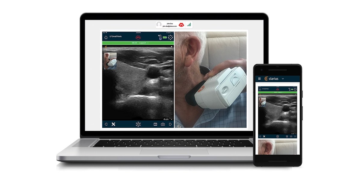 Clarius Simplifies Ultrasound Telemedicine with Latest Release