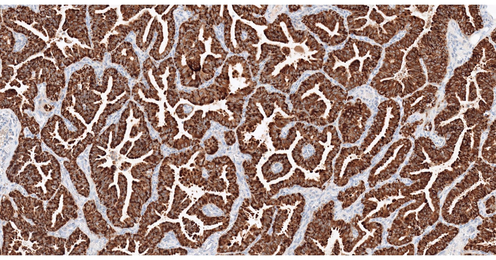 Roche launches first in vitro diagnostic IHC test to detect ROS1 ...