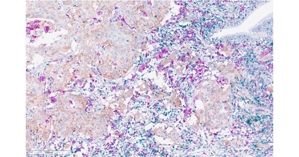 Definiens & Targos Innovation: AI-powered multiplex IHC biomarker ...