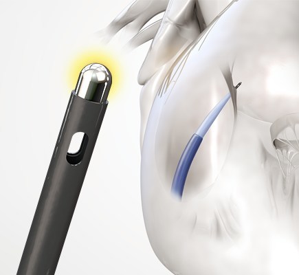 Study Links Use of the Baylis Medical RF Transseptal Needle to ...