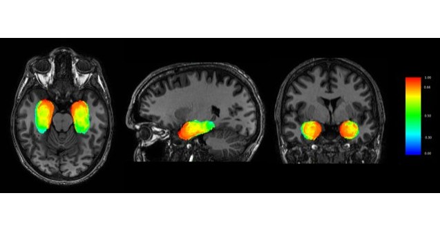 Study Shows Seizure Freedom for Most Epilepsy Patients with Minimally ...