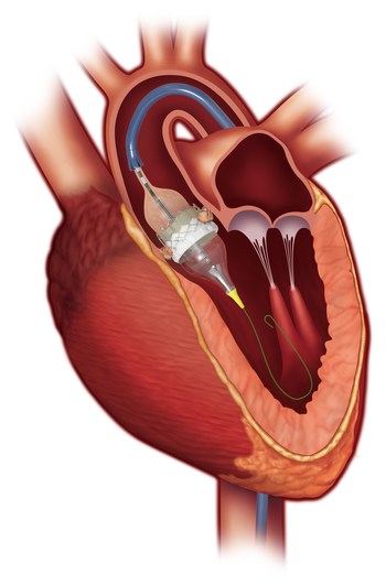 Edwards SAPIEN 3 TAVR Receives FDA Approval For Low-Risk Patients